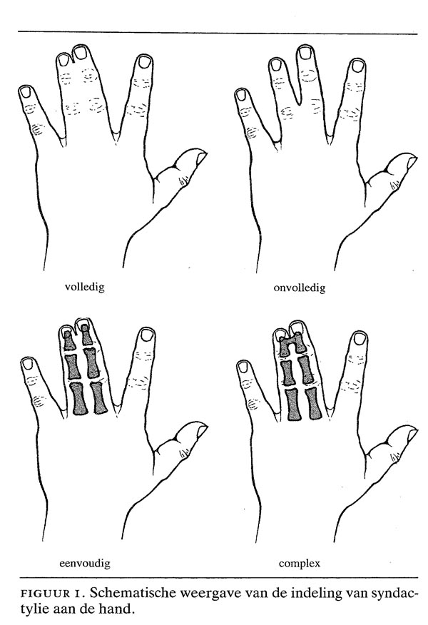 De behandeling van syndactylie en de resultaten bij 31 kinderen ...