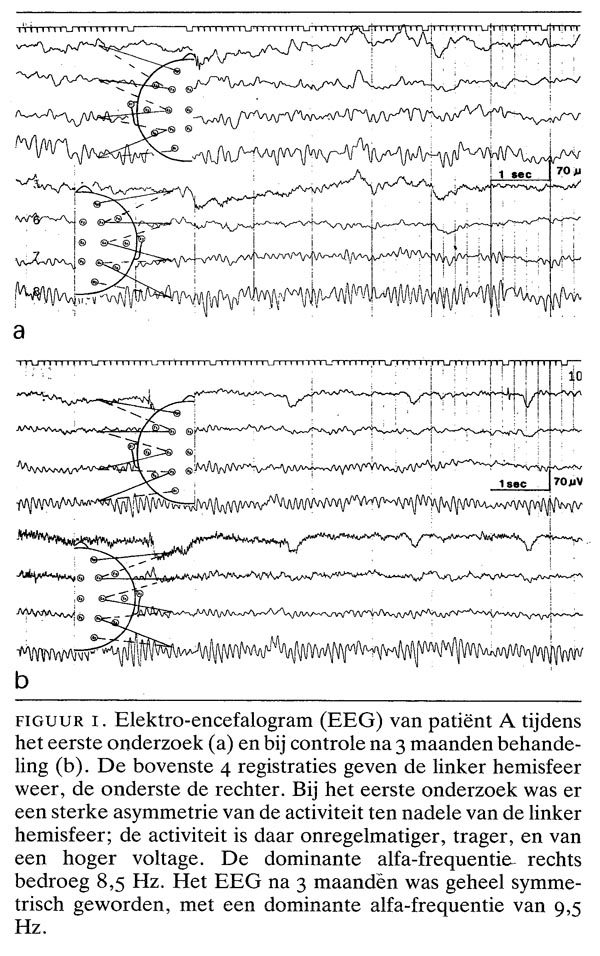 Het nut van een elektro-encefalogram bij een patiënt met voorbijgaande ...