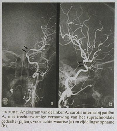 Het nut van een elektro-encefalogram bij een patiënt met voorbijgaande ...