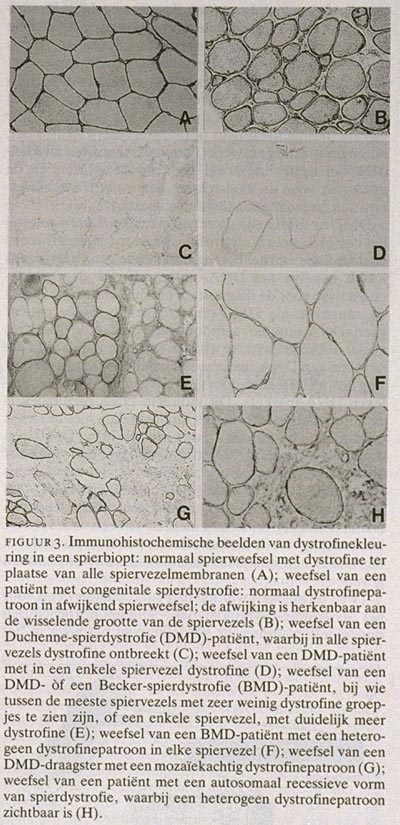 Toepassing van gecombineerde DNA- en dystrofine-eiwitanalyse in de ...
