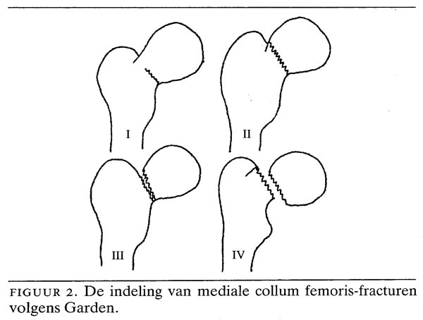 De dynamische heupschroef bij mediale fracturen van het collum femoris ...