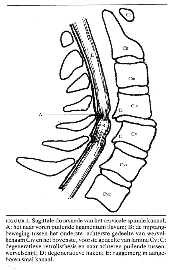 Het centrale-ruggemergsyndroom | Nederlands Tijdschrift voor Geneeskunde