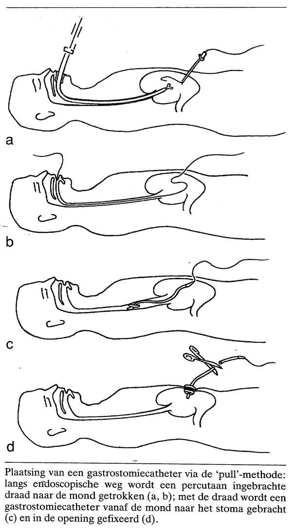 Percutane endoscopische gastrostomie | Nederlands Tijdschrift voor ...