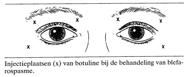 Blefarospasme; resultaten van behandeling met botuline | Nederlands ...