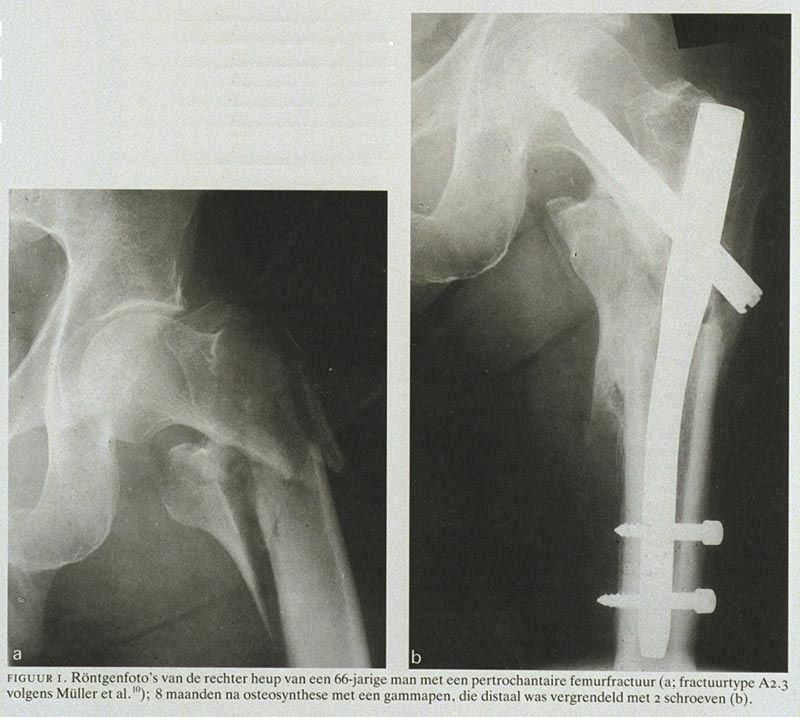 Goede resultaten van behandeling van pertrochantaire femurfracturen met ...