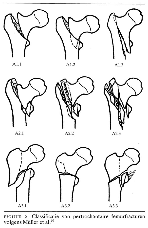 Goede resultaten van behandeling van pertrochantaire femurfracturen met ...