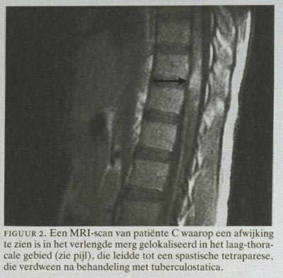 De vele gezichten van de zuurvaste staaf | NTvG