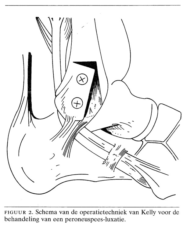 De recidiverende peroneuspees-luxatie | NTVG