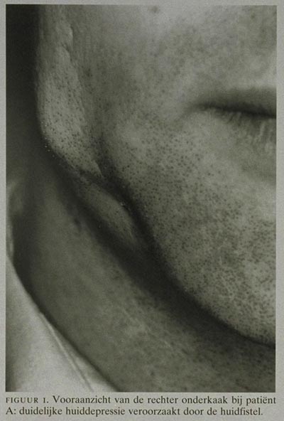 Een fistel in het gelaat; meestal geen huidaandoening | Nederlands ...