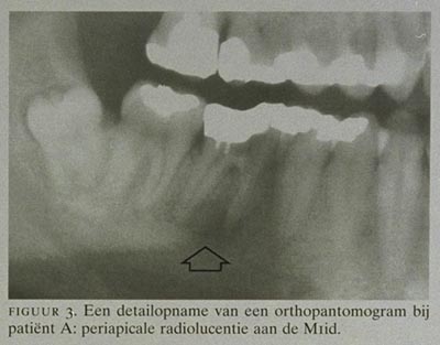 Een fistel in het gelaat; meestal geen huidaandoening | Nederlands ...