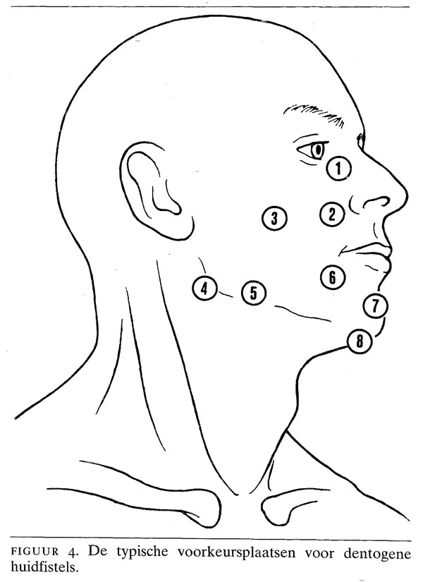 Een fistel in het gelaat; meestal geen huidaandoening | Nederlands ...