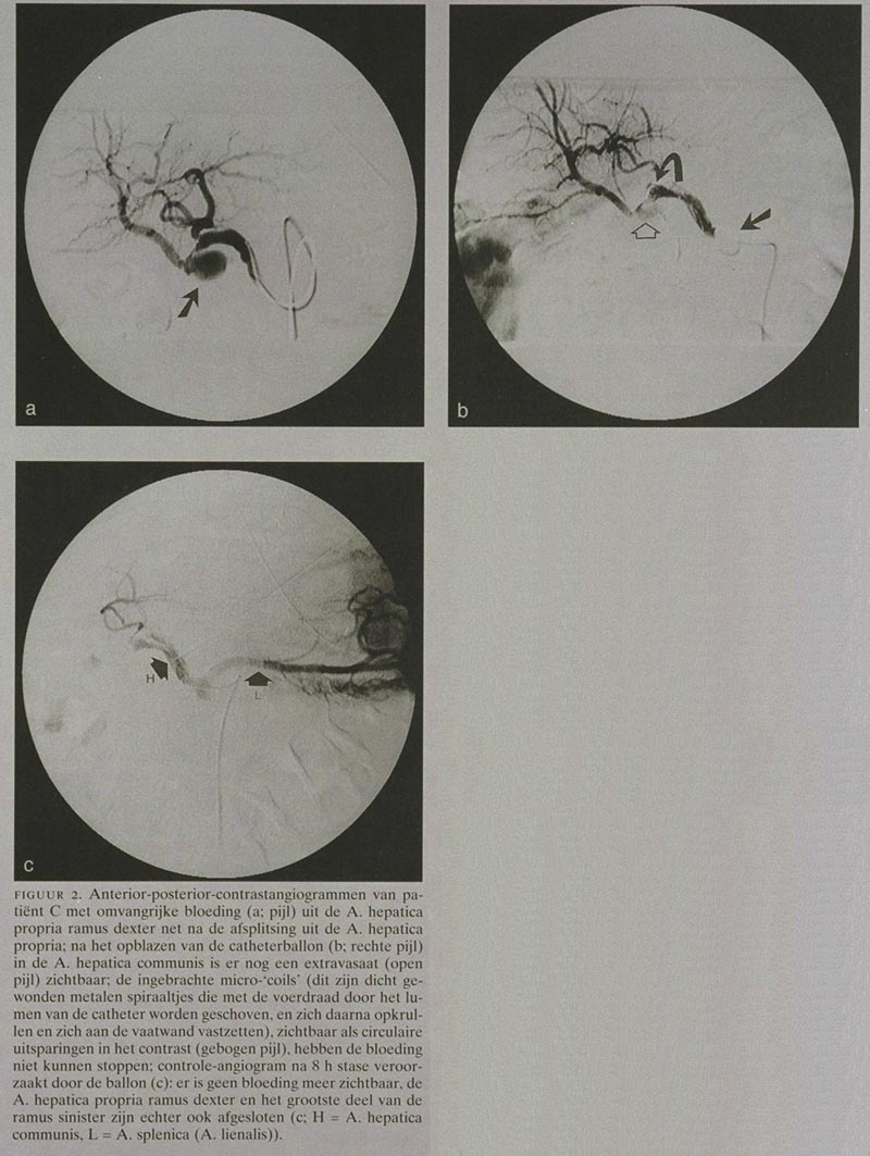Endovasculaire embolisatie bij gastro-intestinale bloedingen | NTvG