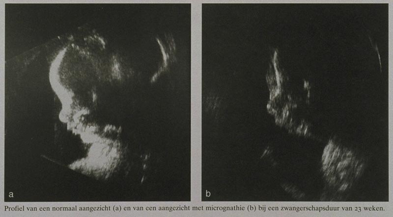 Echoscopische diagnostiek van aangeboren afwijkingen na de 16e ...