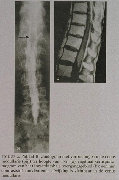 Twee patiënten met een dwarslaesie door tumormetastasen in het ...