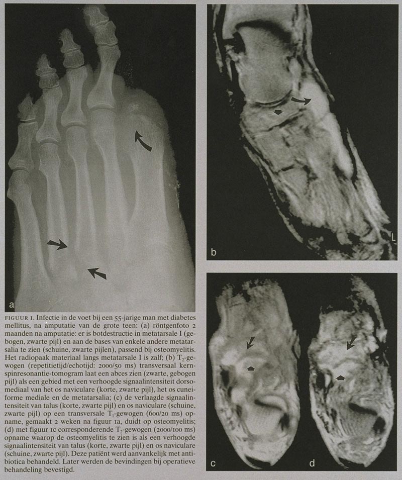 Kernspinresonantie-tomografie van de voet bij patiënten met diabetes ...