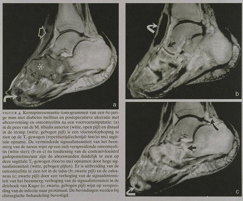 Kernspinresonantie-tomografie van de voet bij patiënten met diabetes ...