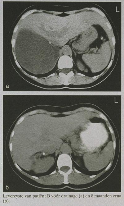 Percutane drainage van benigne niet-parasitaire levercyste ...