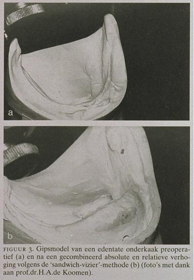 Tandheelkundige behandelingsmogelijkheden voor de edentate patiënt ...