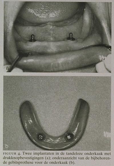 Tandheelkundige behandelingsmogelijkheden voor de edentate patiënt ...