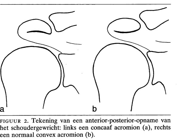 Bevredigende resultaten van operatieve reconstructie van 'rotator cuff ...