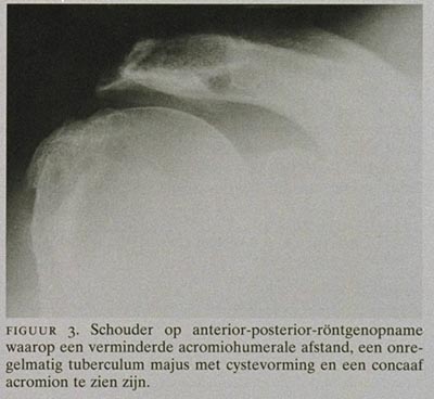 Bevredigende resultaten van operatieve reconstructie van 'rotator cuff ...