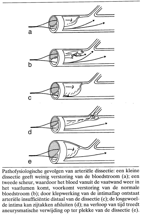 Spontane dissectie van de A. iliaca; behandeling met een stent ...