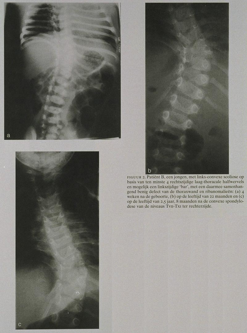 Aangeboren afwijkingen van de wervelkolom: het belang van vroege ...
