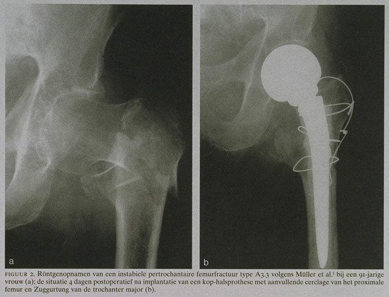 Primaire behandeling van instabiele pertrochantaire femurfracturen met ...