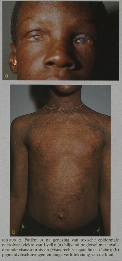 Toxische epidermale necrolyse, een levensbedreigende huidaandoening ...