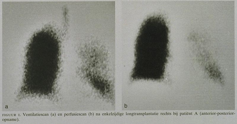 Longtransplantatie: soms een uitkomst bij longfibrose | NTvG