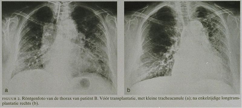 Longtransplantatie: soms een uitkomst bij longfibrose | NTvG