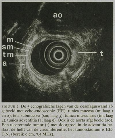 Echo-endoscopie bij de diagnostiek van maligne oesofagustumoren ...