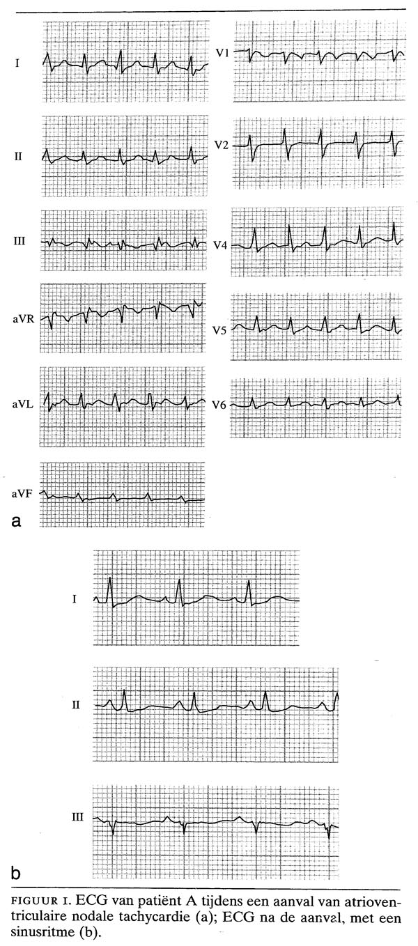 Supraventriculaire tachycardie bij een gravida met malaria tertiana ...