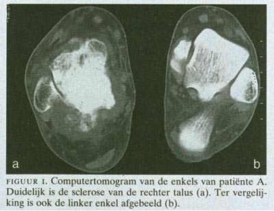 Botpijnen bij patiënten met kanker berusten niet altijd op ...