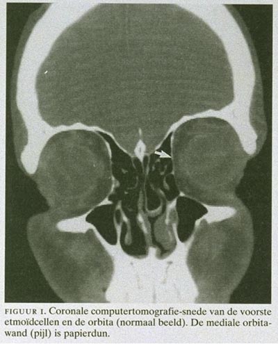 Behandeling van acute etmoïditis volgens een protocol gebaseerd op het ...