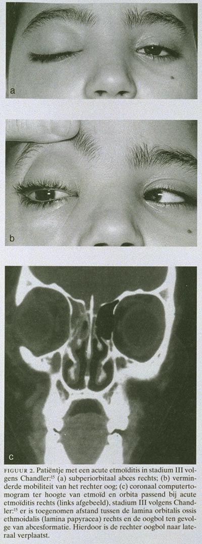 Behandeling van acute etmoïditis volgens een protocol gebaseerd op het ...