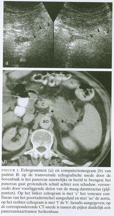 Echografie van de bovenbuik; schijn kan bedriegen | Nederlands ...