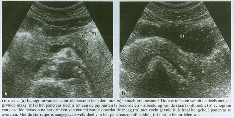 Echografie van de bovenbuik; schijn kan bedriegen | Nederlands ...