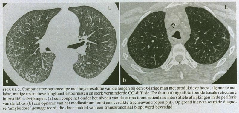 Computertomografie van de longen met hoge resolutie: nieuwe ...