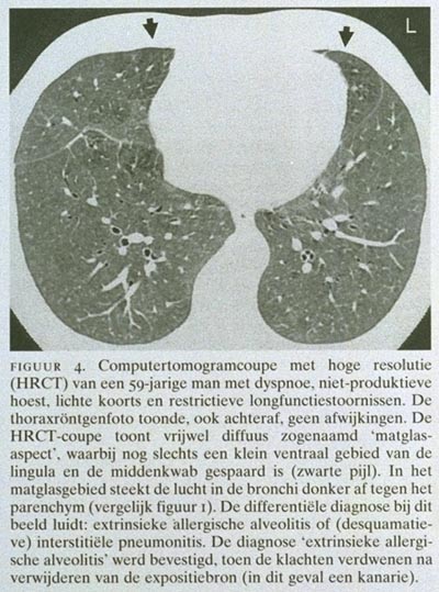 Computertomografie van de longen met hoge resolutie: nieuwe ...