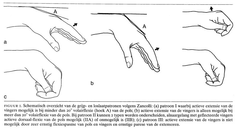 Operatieve mogelijkheden bij spastisch verlamde arm en hand ...