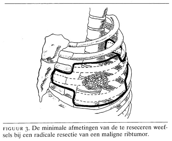 Chondrosarcoom van de benige thoraxwand | Nederlands Tijdschrift voor ...