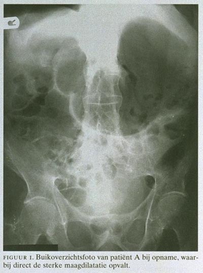 Intestinale pseudo-obstructie tijdens gebruik van baclofen | Nederlands ...