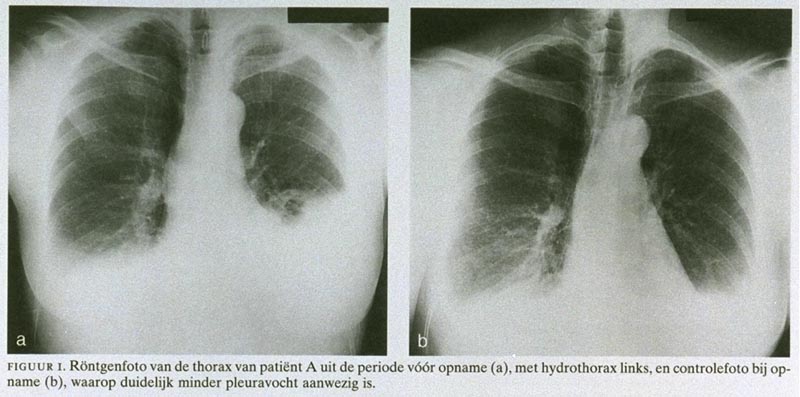 Ascites, hydrothorax en ovariumtumor: syndroom van Meigs, bij een ...