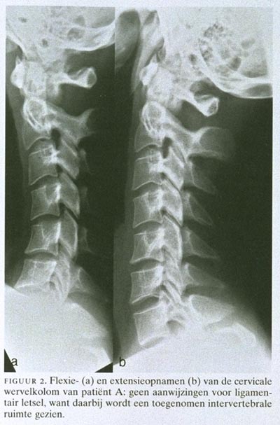 Cervicale avulsiefractuur door airbag | Nederlands Tijdschrift voor ...