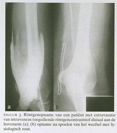 De behandeling van extravasatie van intraveneus toegediende middelen | NTvG