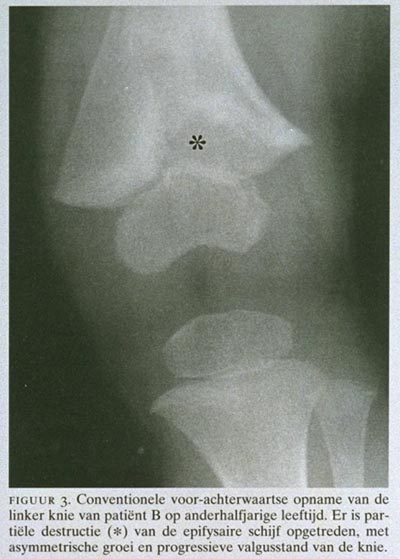 Neonatale osteomyelitis: een aparte categorie qua beeld en beloop ...