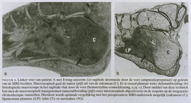 Weke-delenzwelling van de voet niet altijd benigne | NTVG