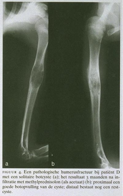 Een onschuldige botcyste in de proximale humerus | Nederlands ...
