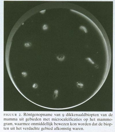 Digitale röntgengestuurde dikkenaaldbiopsie als alternatief voor ...